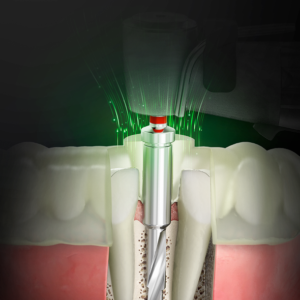 Dental Implant - Dentis USA