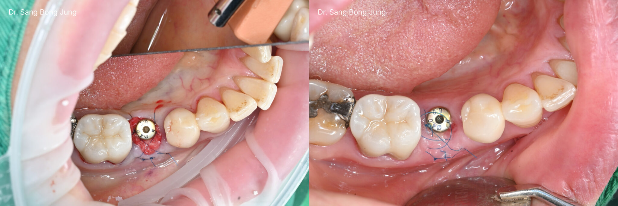 Optimal Fixture for Immediate Implant Placement: SQ Mini in Premolars